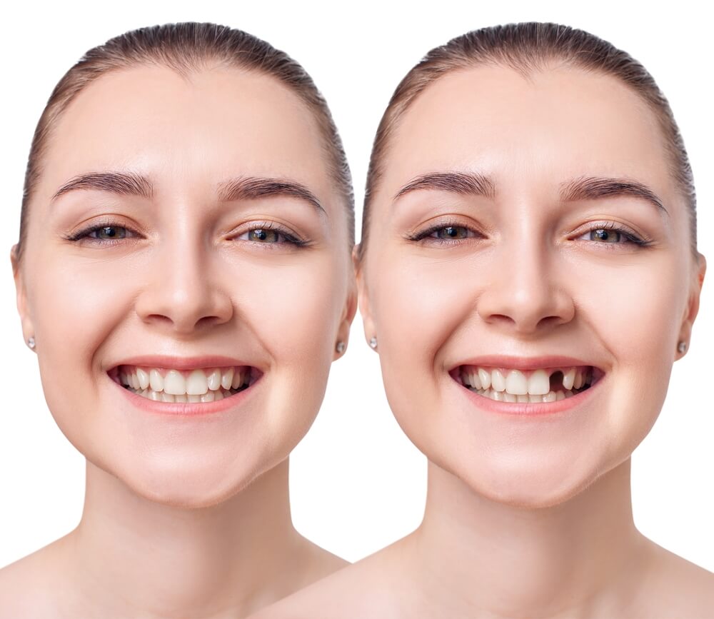 How to Fix a Tooth That Fell Out of Dentures | Dr Ben Lee